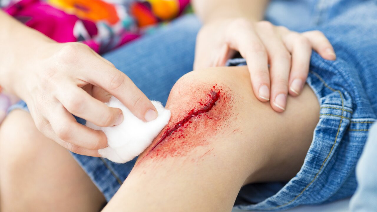 Erste Hilfe bei Blutungen und offenen Wunden - hkk-magazin