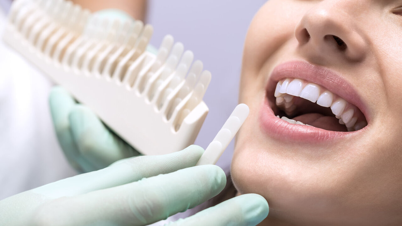 Zahnbleaching: Methoden, was beachten? - hkk-magazin